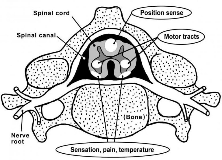 Regenerative Therapy for Spinal cord injury treatment - Medica Institute